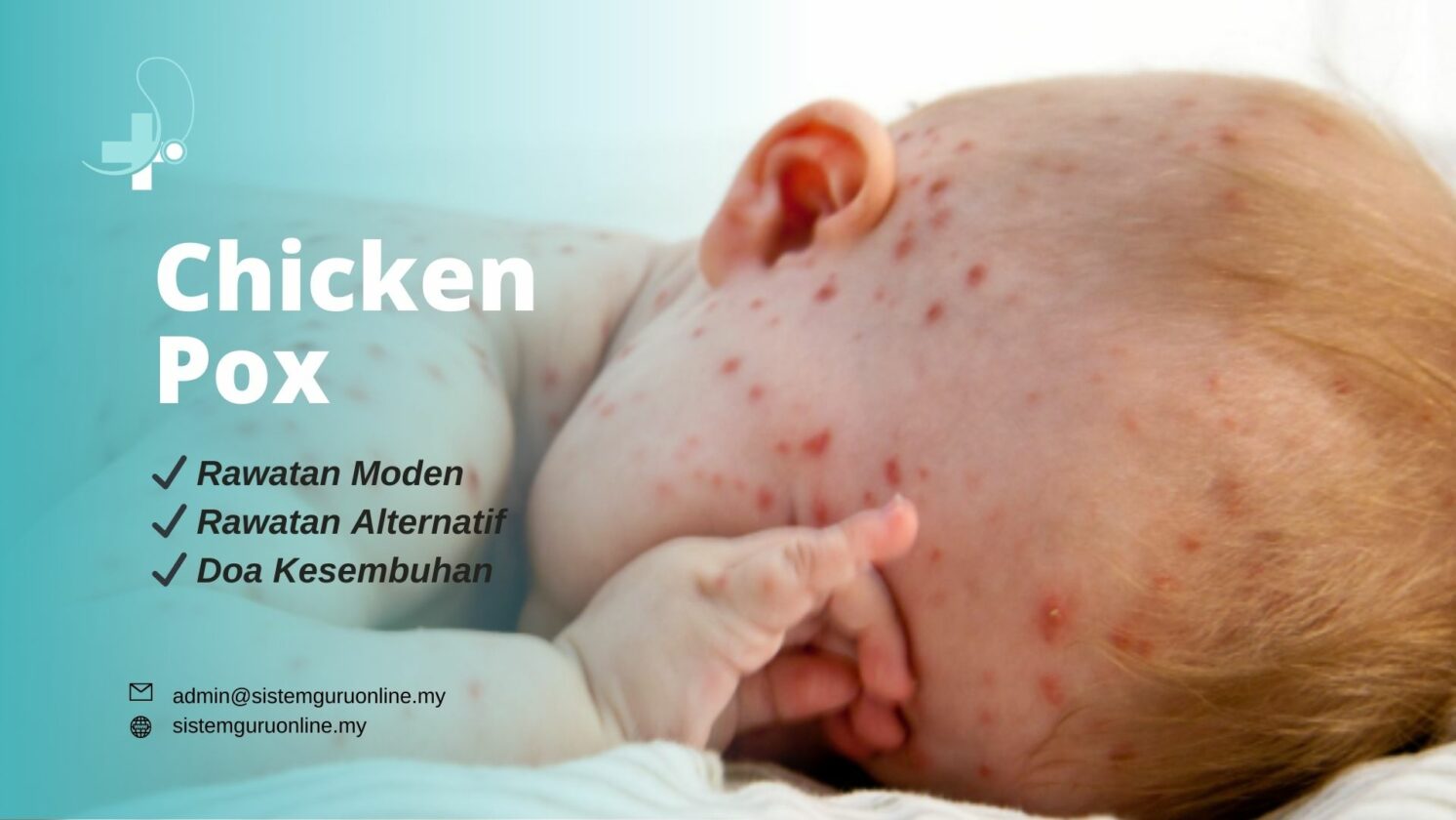 Gejala Chicken Pox Yang Serius Pada Anak Anda Serta 5 Rawatan Alternatif