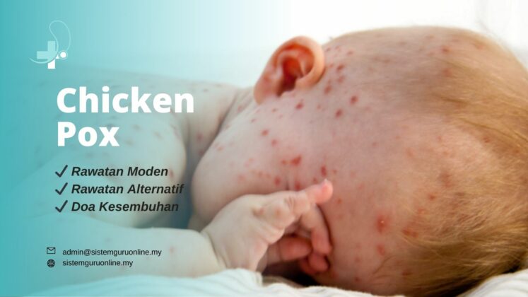 Gejala Chicken Pox Yang Serius Pada Anak Anda Serta 5 Rawatan Alternatif