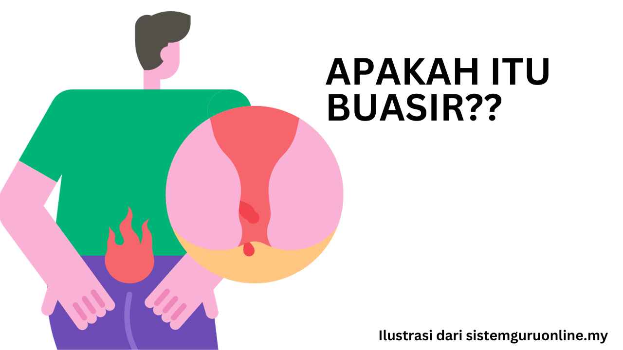 5 Cara Nak Kecutkan Buasir Luar Dan Dalam