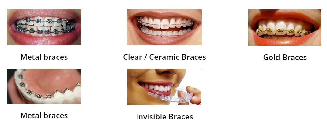 Prosedur Dan Harga Pakai Braces Gigi Dan Perkara Yang Anda Perlu Tahu