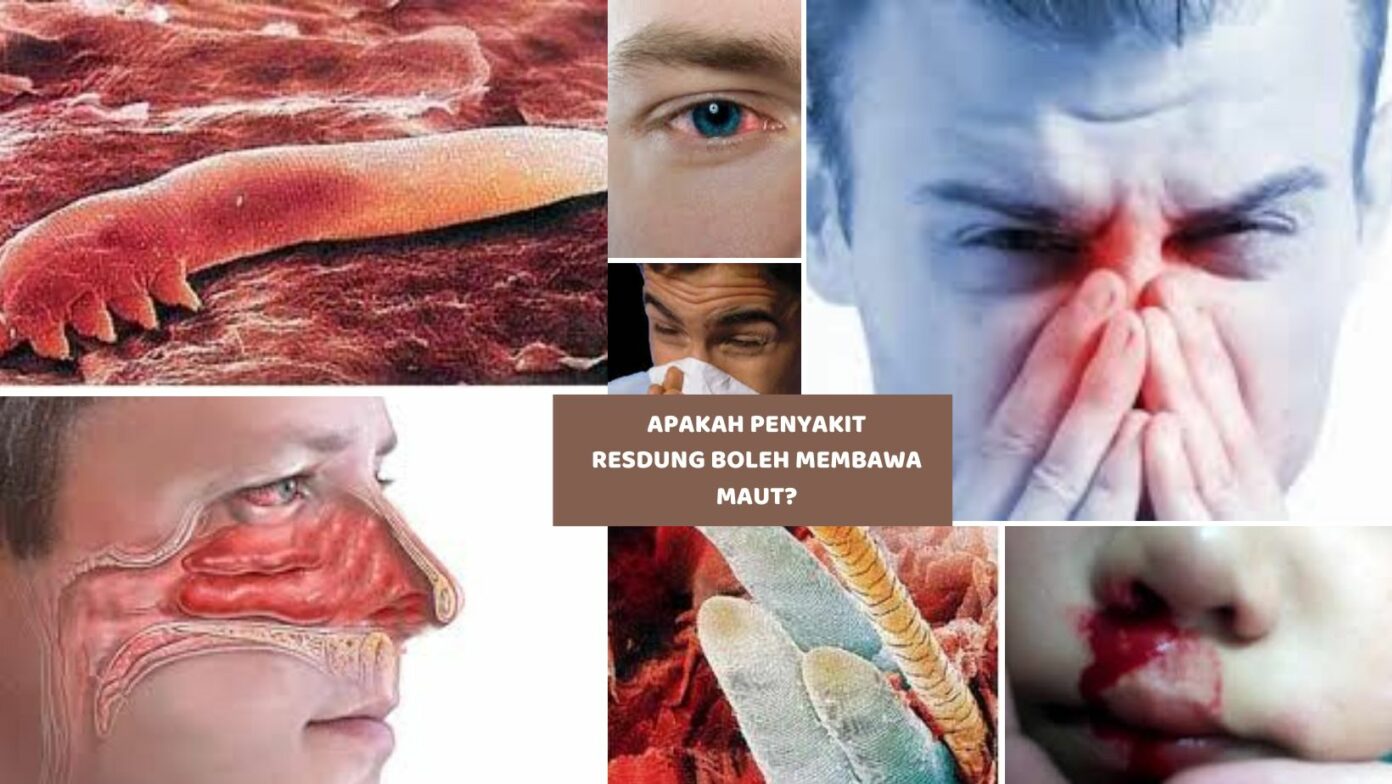 9 Punca Resdung Beserta Petua Menghilangkan Resdung