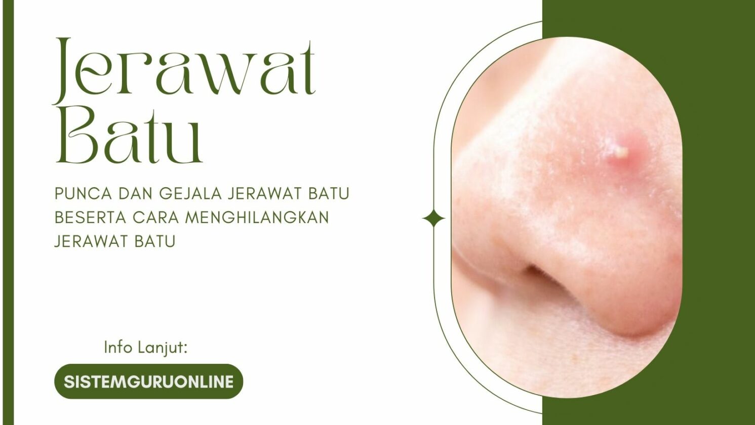 5 Punca Dan Gejala Jerawat Batu Beserta Cara Menghilangkan Jerawat Batu