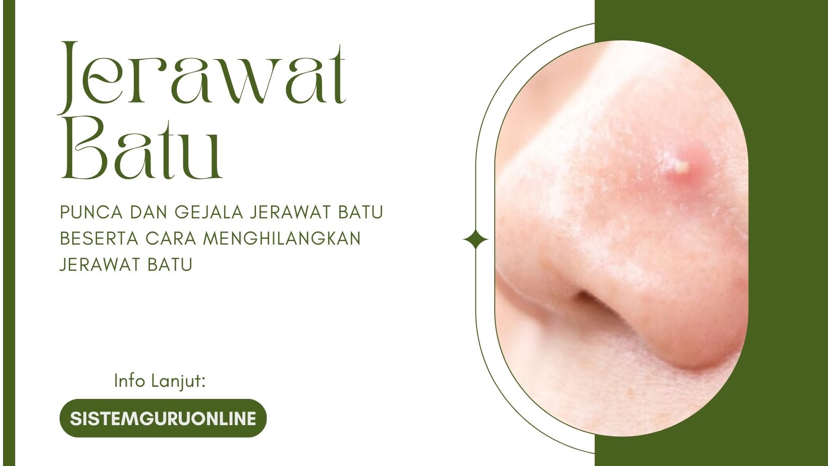 5 Punca Dan Gejala Jerawat Batu Beserta Cara Menghilangkan Jerawat Batu