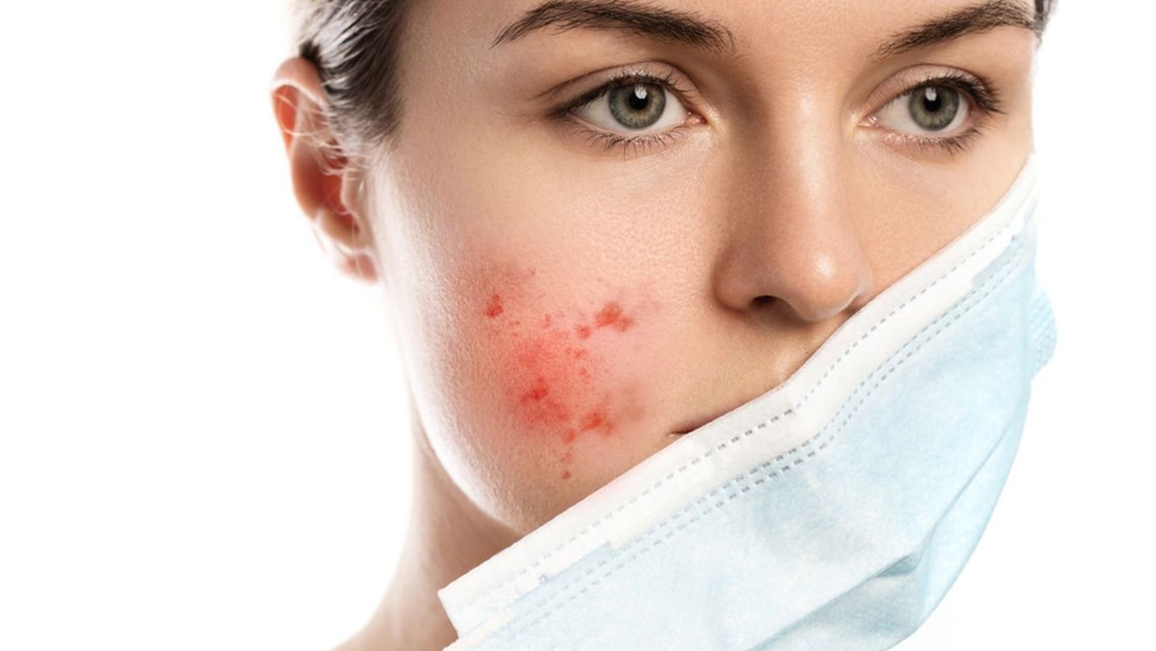 5 Punca Dan Gejala Jerawat Batu Beserta Cara Menghilangkan Jerawat Batu