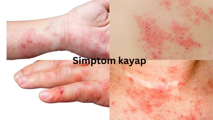 9 Simptom Penyakit Kayap Dan Kaedah Merawat Kayap Yang Berkesan