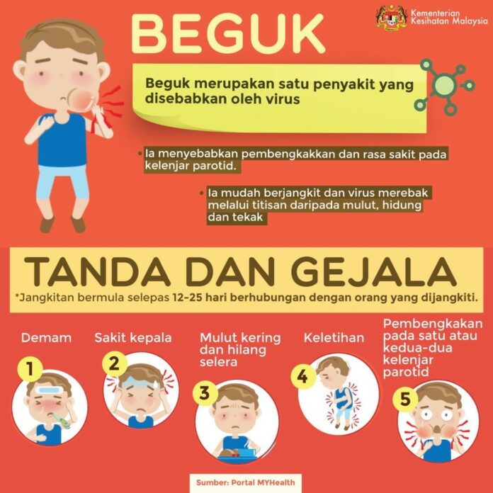 Beguk Mudah Menjangkit Pada Kanak-kanak Dan 5 Gejala Jangkitan Virus Beguk