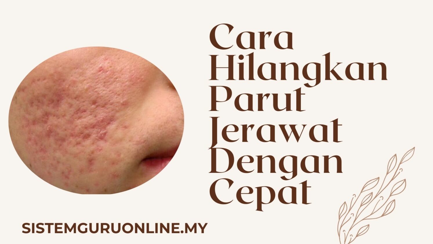 Cara Hilangkan Parut Jerawat Dengan Cepat