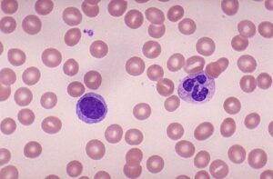 Tanda-tanda Kanser Darah Dan 4 Komplikasi Serius Jika Tidak Dirawat