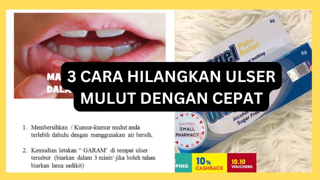 3 Cara Hilangkan Ulser Mulut Dengan Cepat