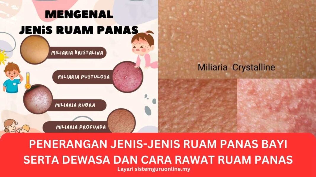 Penerangan Jenis-Jenis Ruam Panas Bayi Serta Dewasa Dan Cara Rawat Ruam ...